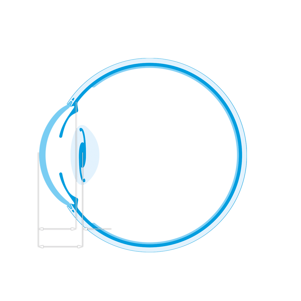 EyeSuite IOL - Barrett Universal II - a formula for all seasons