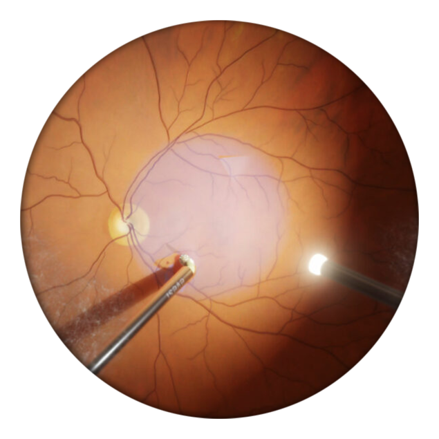 detached retina vision simulation