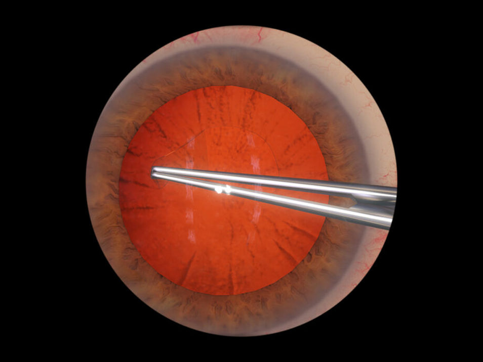 Eyesi Surgical - Standardized curriculum